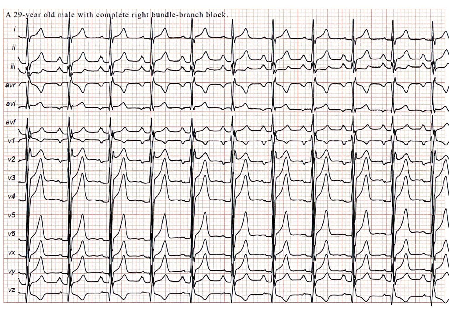 Topic - Complete Right Bundle-Branch Block | 12-Lead ECG Certification ...