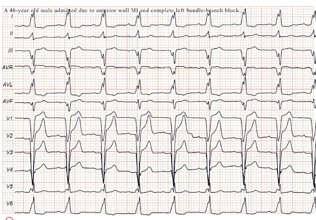 Topic - Complete Left Bundle-Branch Block | 12-Lead ECG Certification ...