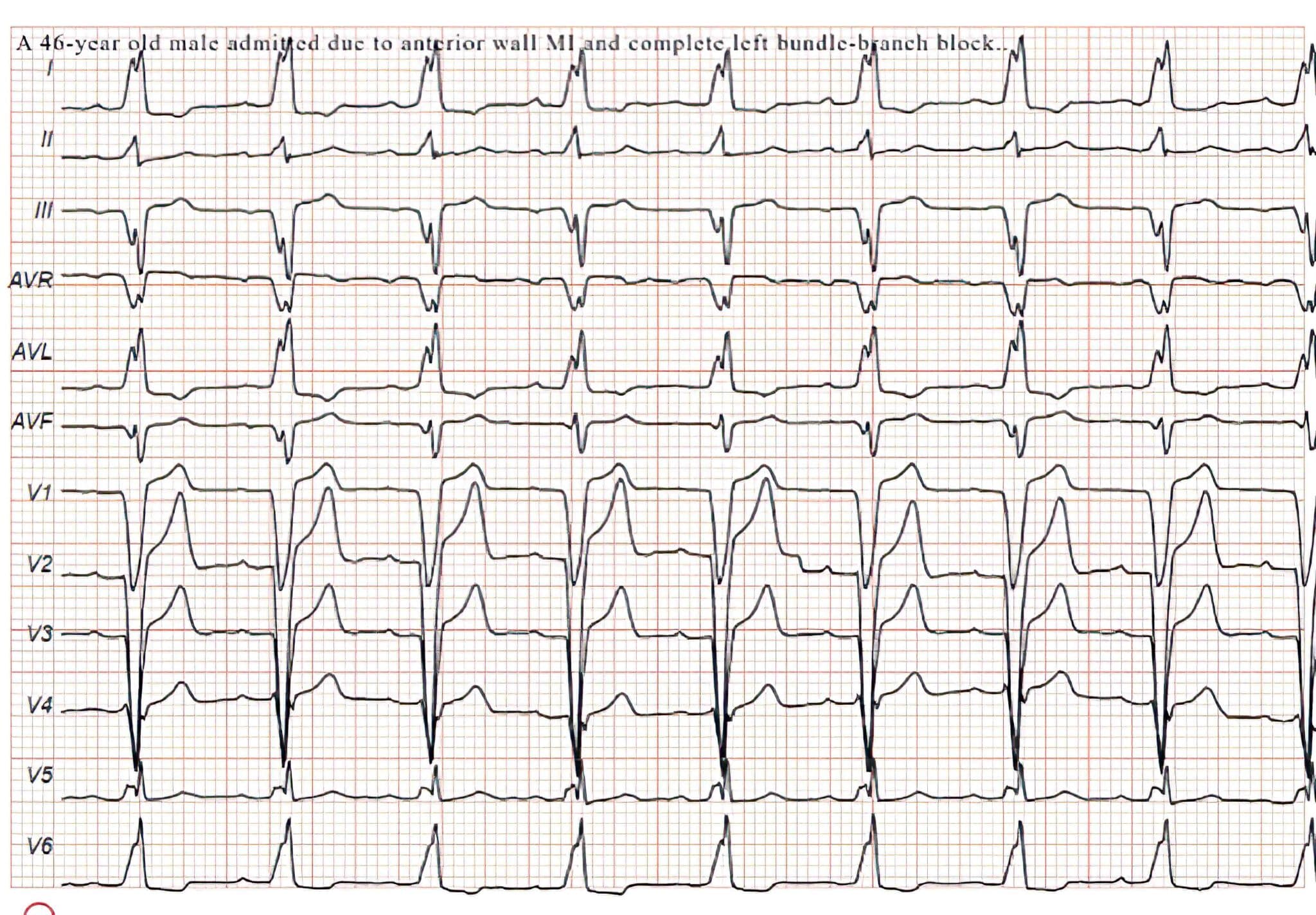 Topic - Complete Left Bundle-Branch Block | 12-Lead ECG Certification ...