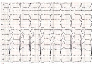Topic - Complete Left Bundle-Branch Block | 12-Lead ECG Certification ...