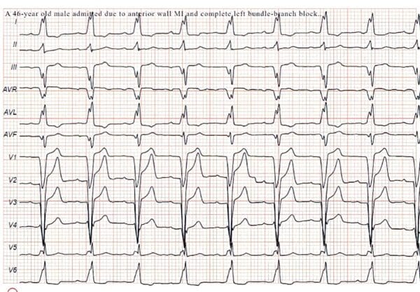 Topic - Complete Left Bundle-Branch Block | 12-Lead ECG Certification ...