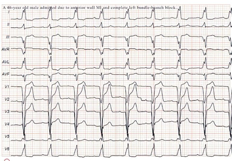 Topic - Complete Left Bundle-Branch Block | 12-Lead ECG Certification ...