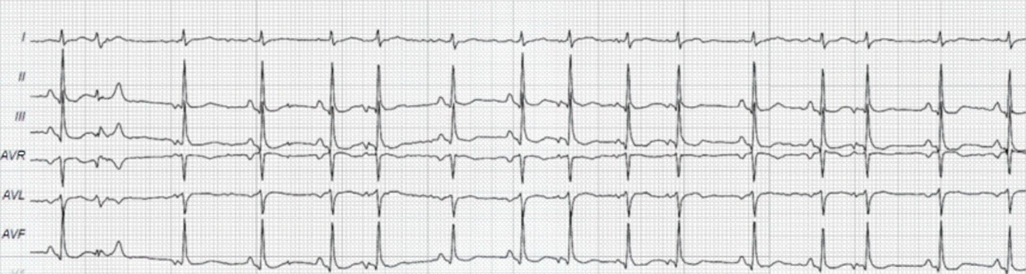 Topic - Premature Atrial Contractions in the Inferior Aspect of the ...