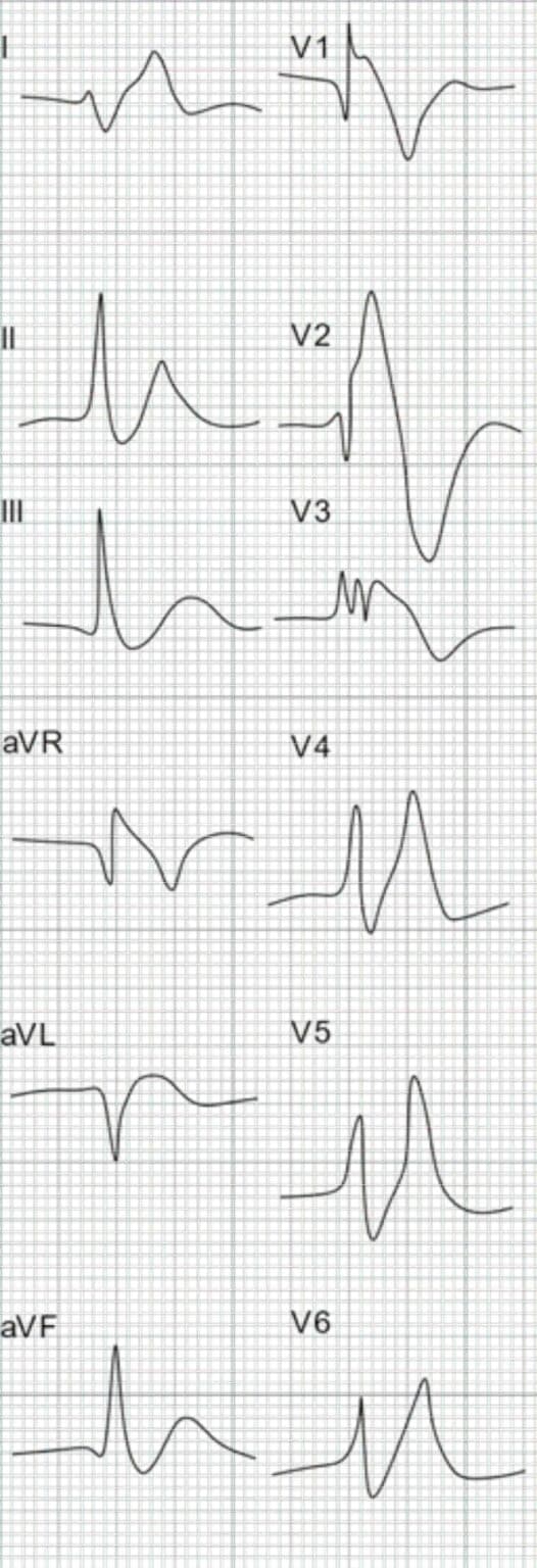 Topic - Hyperkalemia | 12-Lead ECG Certification Course | ACLS ...