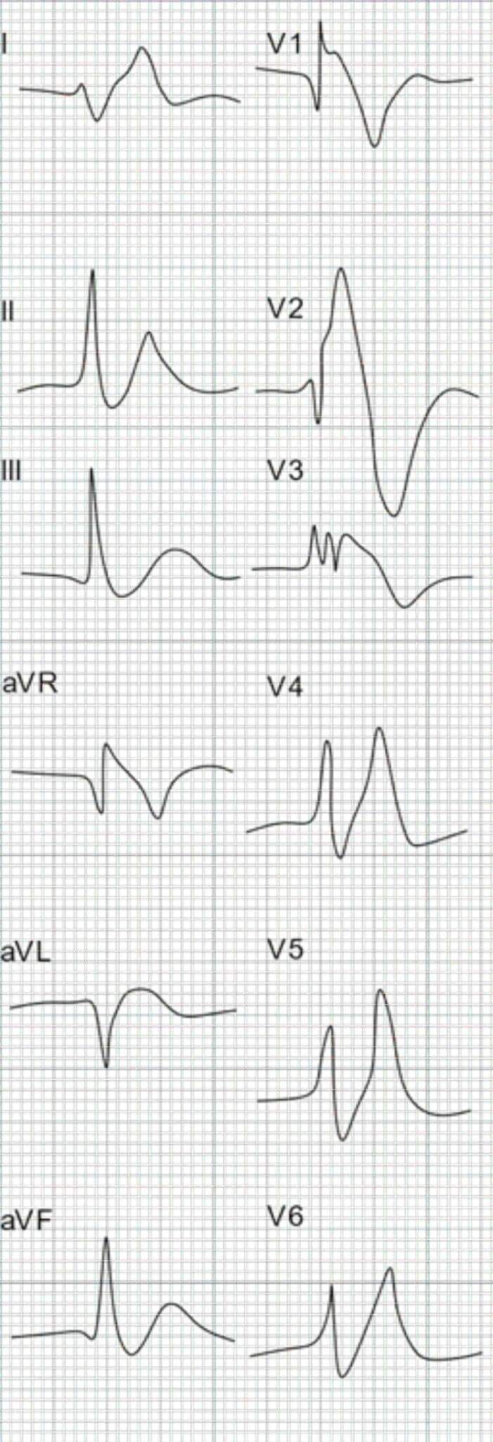 Topic - Hyperkalemiav | 12 Lead ECG Course | ACLS Certification Association