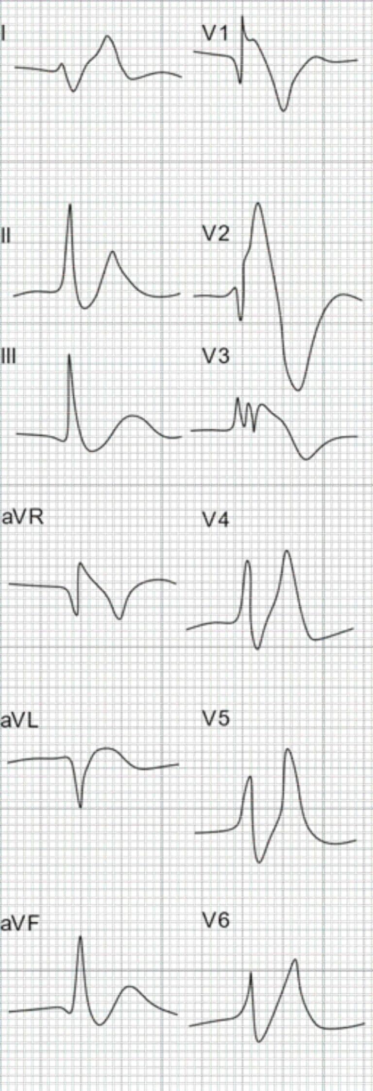 Topic - Hyperkalemiav | 12 Lead ECG Course | ACLS Certification Association