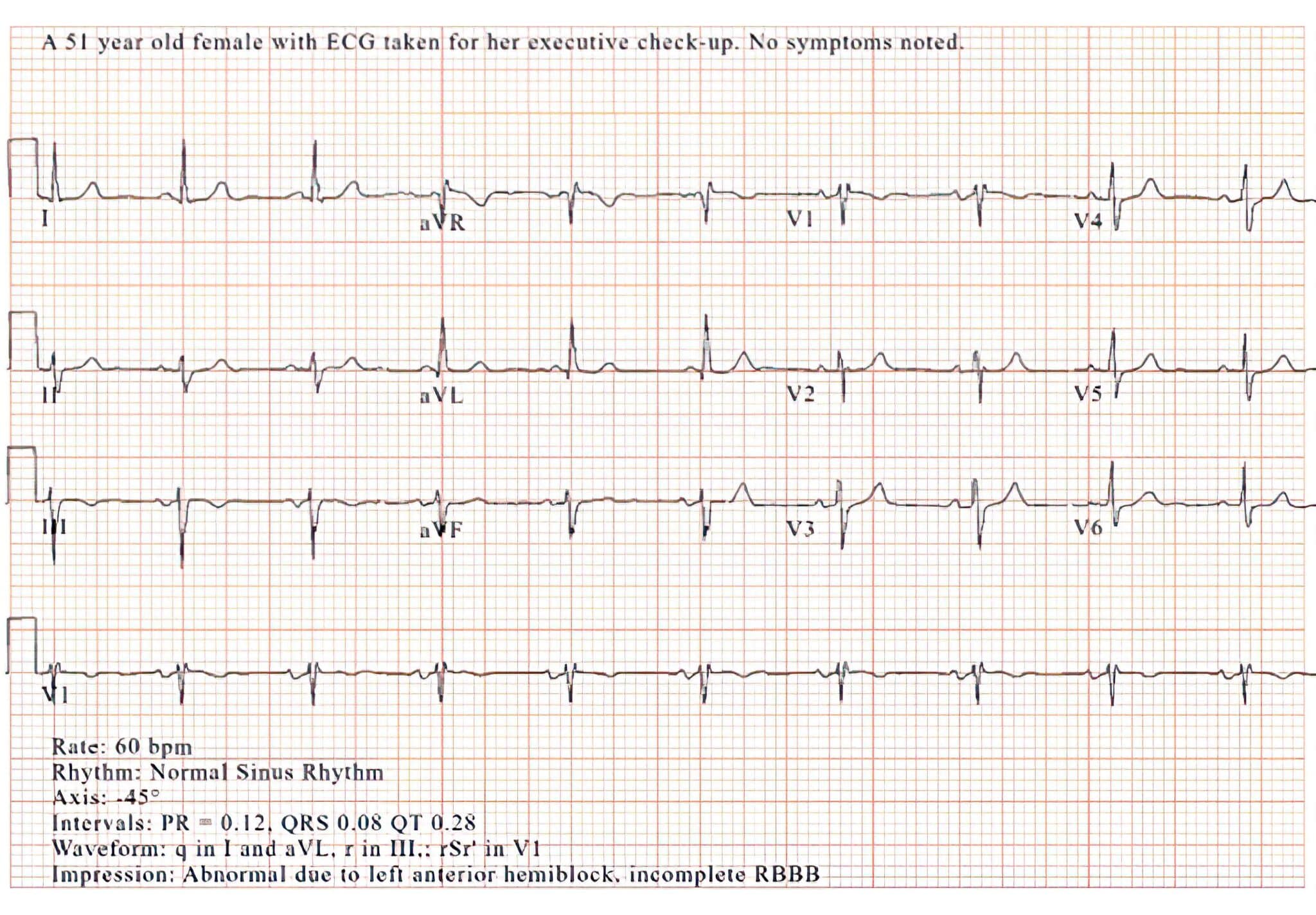 Topic - Fascicular Blocks Case 1 | 12-Lead ECG Certification Course ...