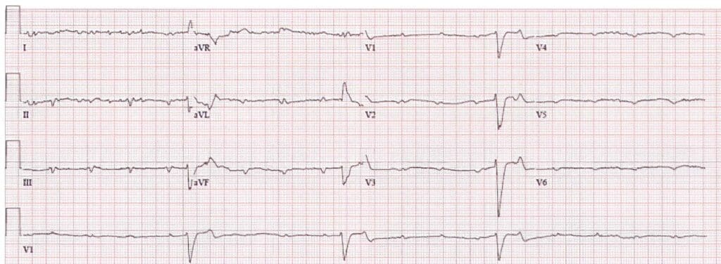 Topic - Second-Degree Atrioventricular Block, Mobitz Type II | 12 Lead ...