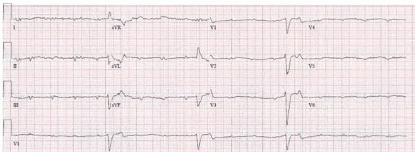 Topic - Second-Degree Atrioventricular Block, Mobitz Type II | 12-Lead ...
