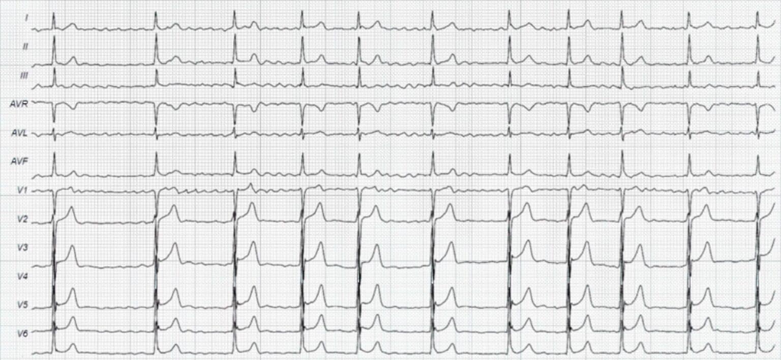 Topic - Atrial Fibrillation | 12 Lead ECG Course | ACLS Certification ...