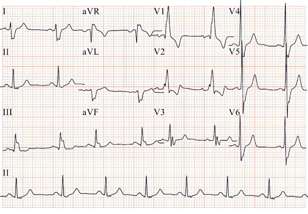 Topic - Right Bundle-Branch Block + Left Posterior Fascicular Block ...
