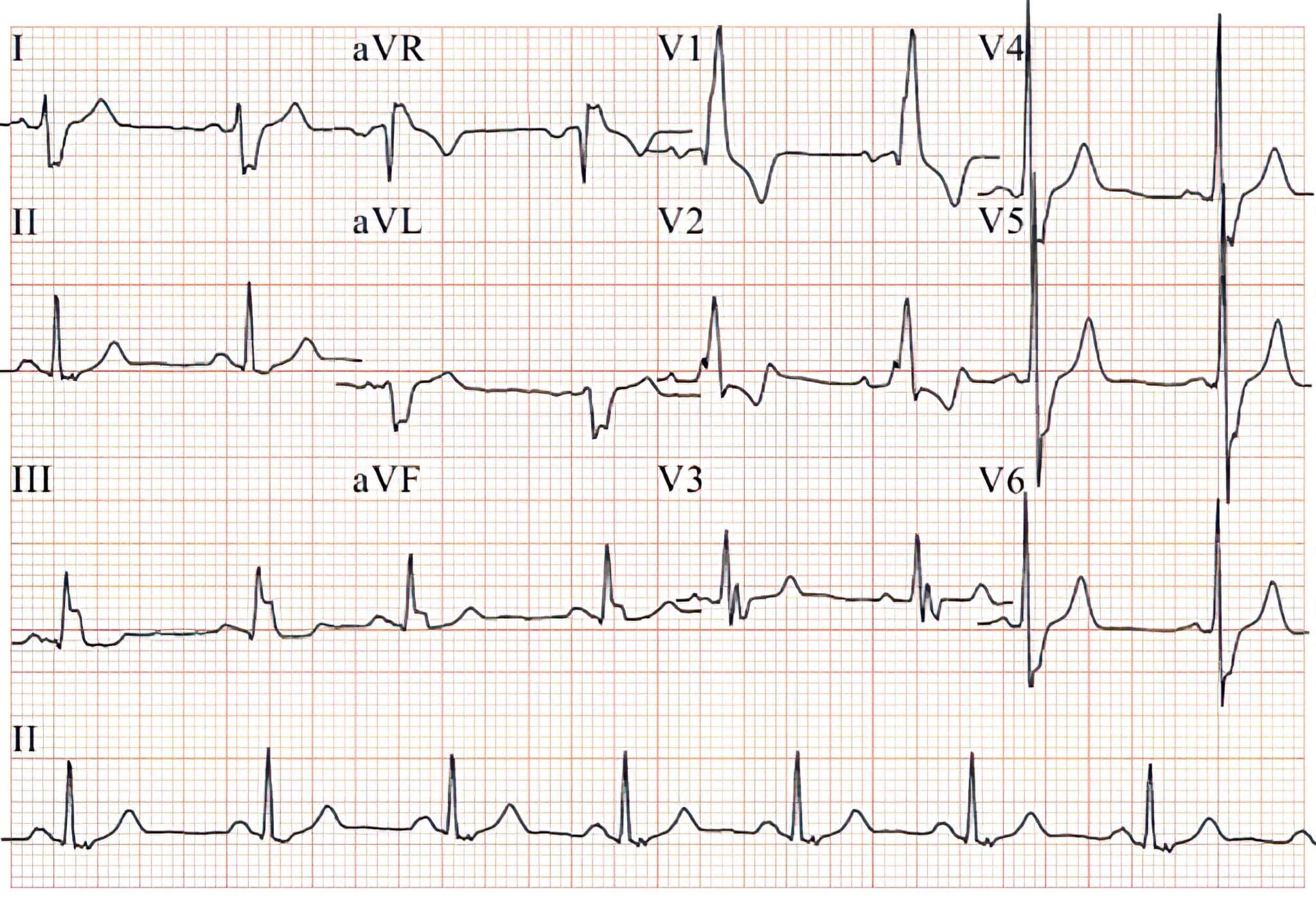 Topic - Right Bundle-Branch Block + Left Posterior Fascicular Block ...