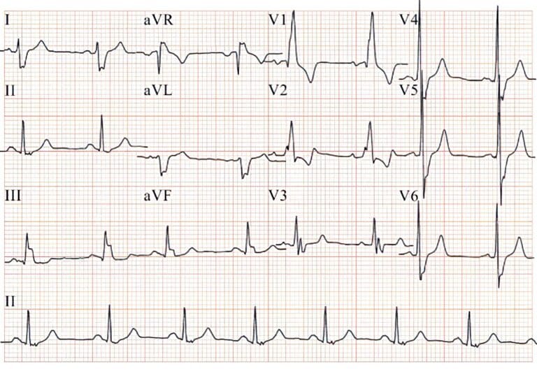 Topic - Right Bundle-Branch Block + Left Posterior Fascicular Block ...