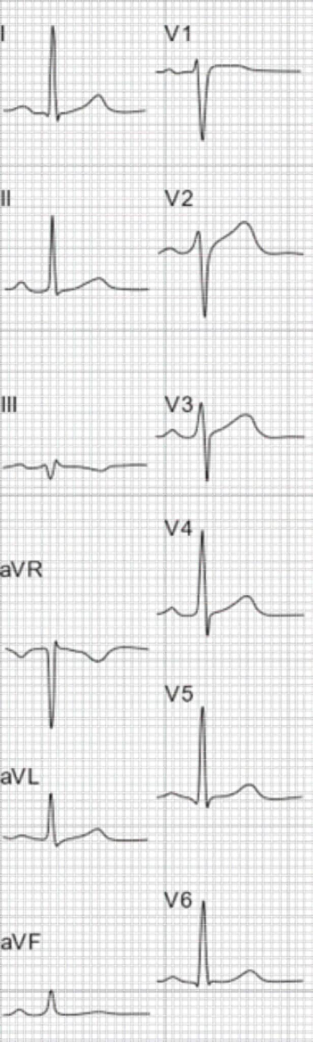 Topic - Changes in the T Wave | 12 Lead ECG Course | ACLS Certification ...