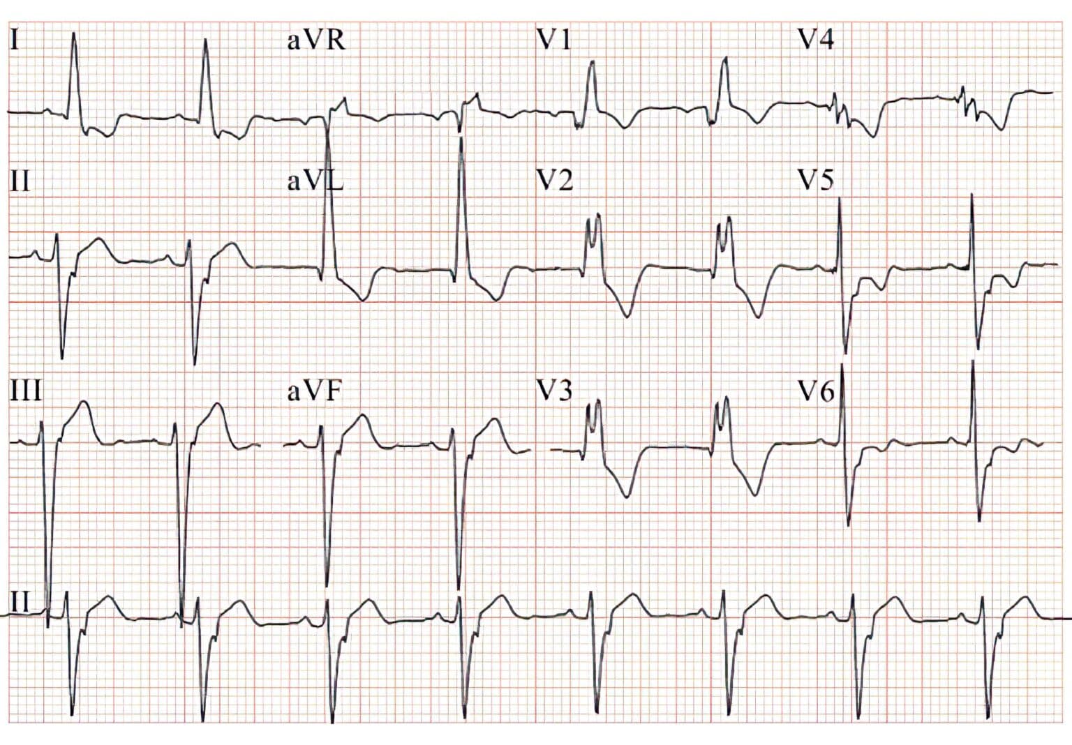 Topic - Right Bundle-Branch Block with Left Anterior Fascicular Block ...