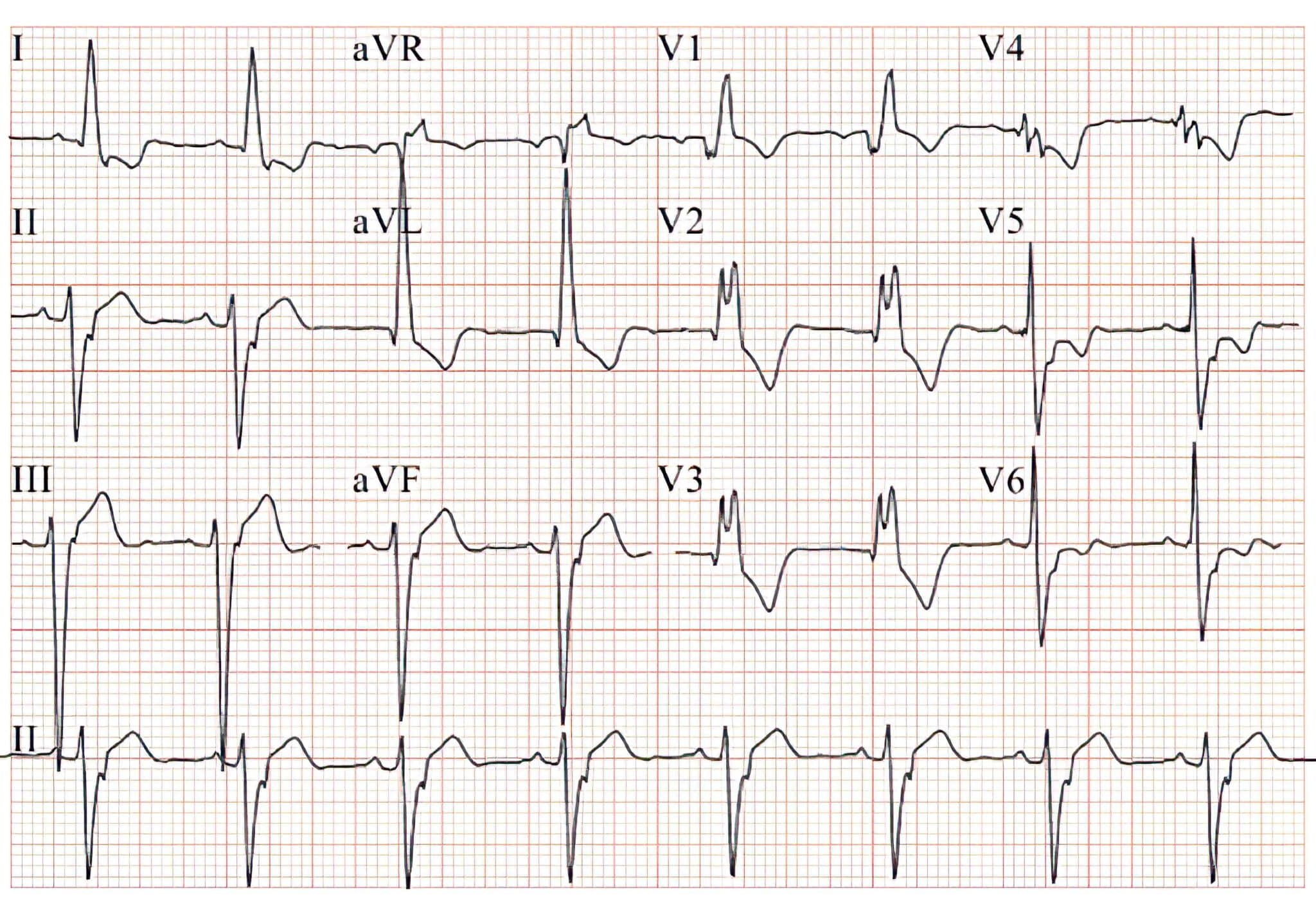 Topic - Right Bundle-Branch Block with Left Anterior Fascicular Block ...