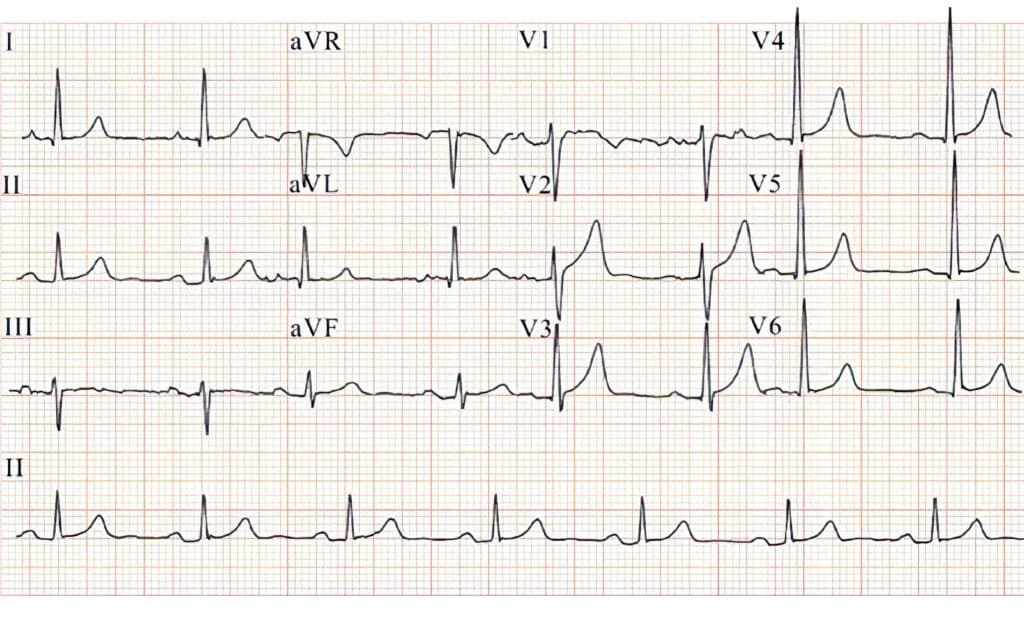 Topic - First-Degree AV Block | 12-Lead ECG Certification Course | ACLS ...
