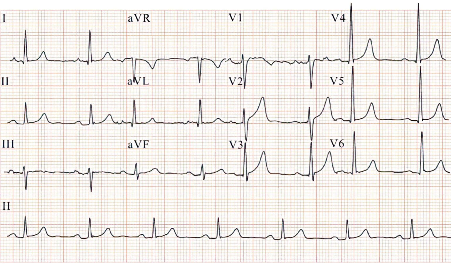 Topic - First-Degree AV Block | 12-Lead ECG Certification Course | ACLS ...