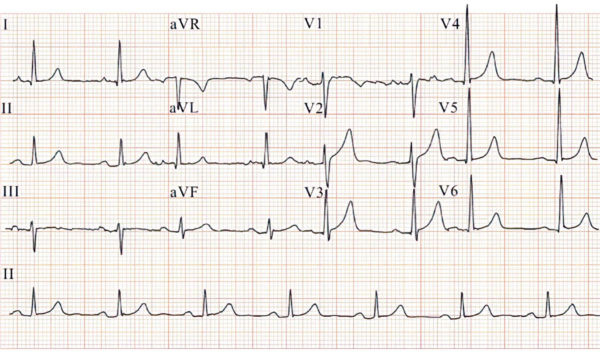 Topic - First-Degree AV Block | 12-Lead ECG Certification Course | ACLS ...
