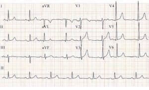 Topic - First-Degree AV Block | 12 Lead ECG Course | ACLS Certification ...