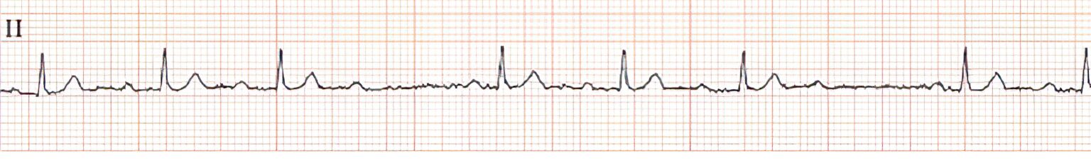 Topic - Second-Degree AV Block, Mobitz Type I (Wenckebach Type) | 12 ...