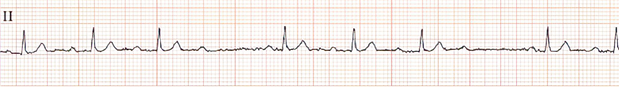 Topic - Second-Degree AV Block, Mobitz Type I (Wenckebach Type) | 12 ...