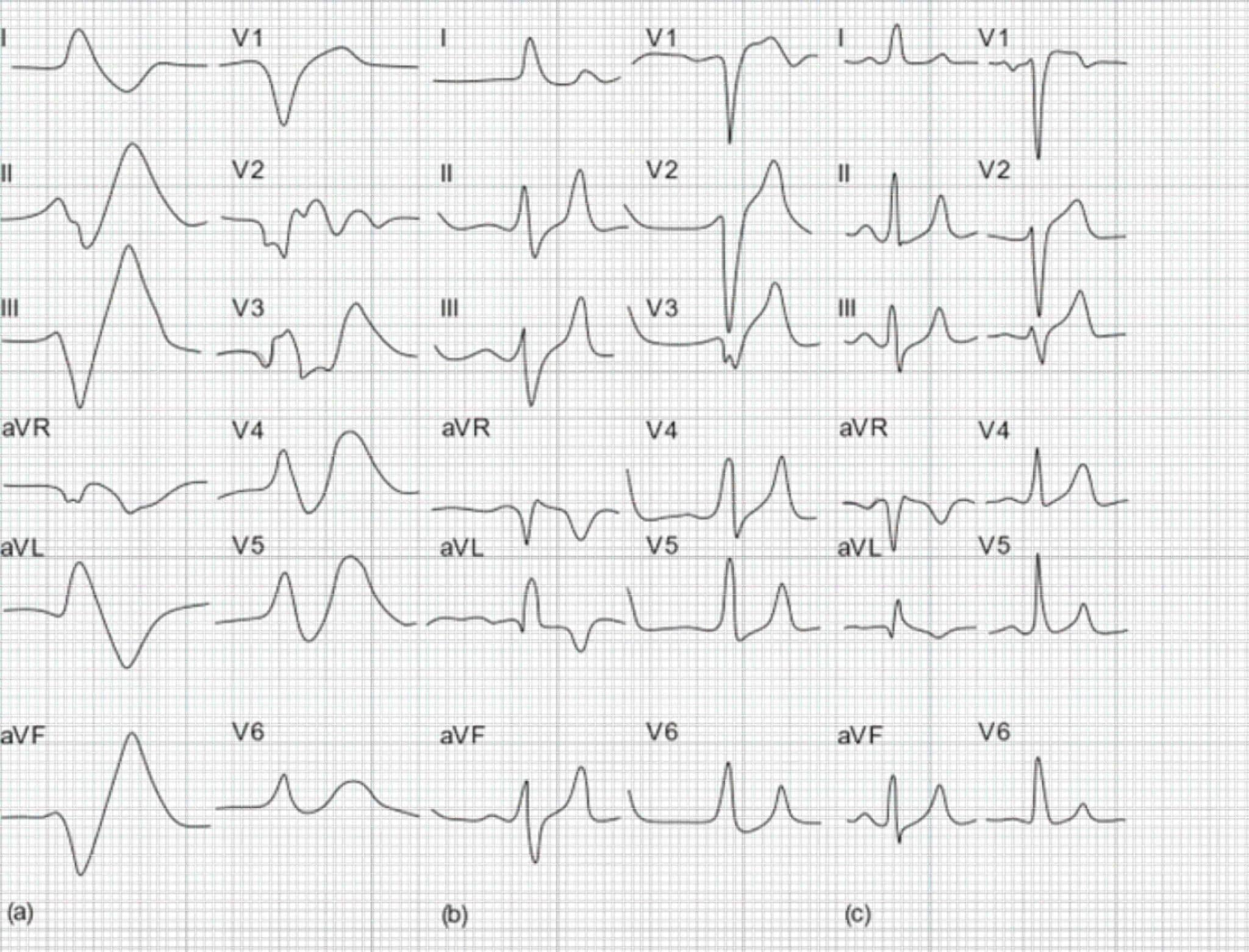 Topic - Hyperkalemia | 12-Lead ECG Certification Course | ACLS ...