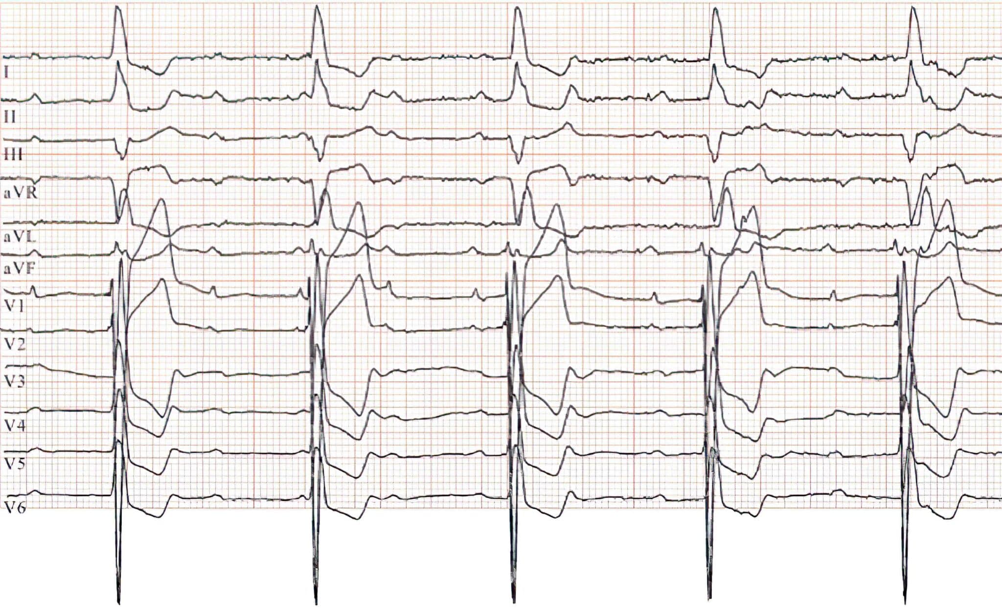 Topic - Third-Degree AV Block, Complete AV Block | 12-Lead ECG ...