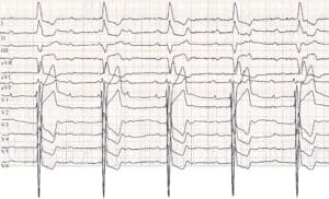 Topic - Third-Degree AV Block, Complete AV Block | 12-Lead ECG ...