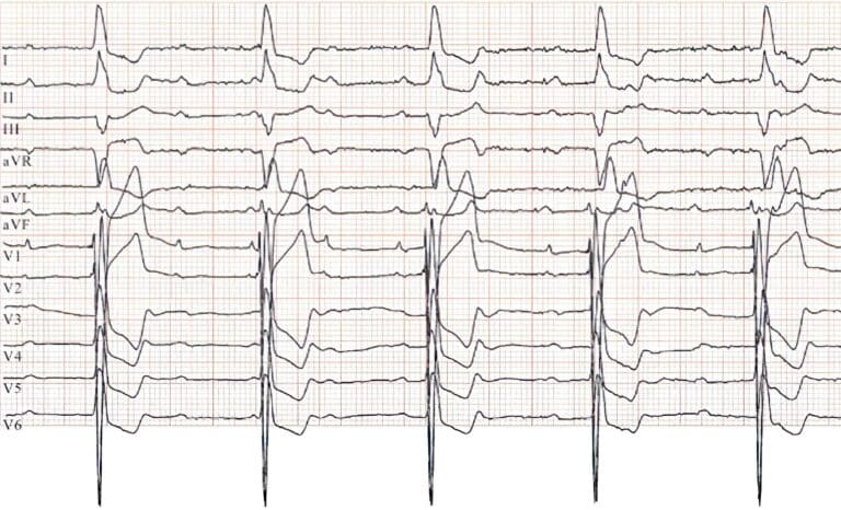 Topic - Third-Degree AV Block, Complete AV Block | 12-Lead ECG ...