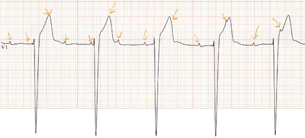 Topic - Third-Degree AV Block, Complete AV Block | 12-Lead ECG ...