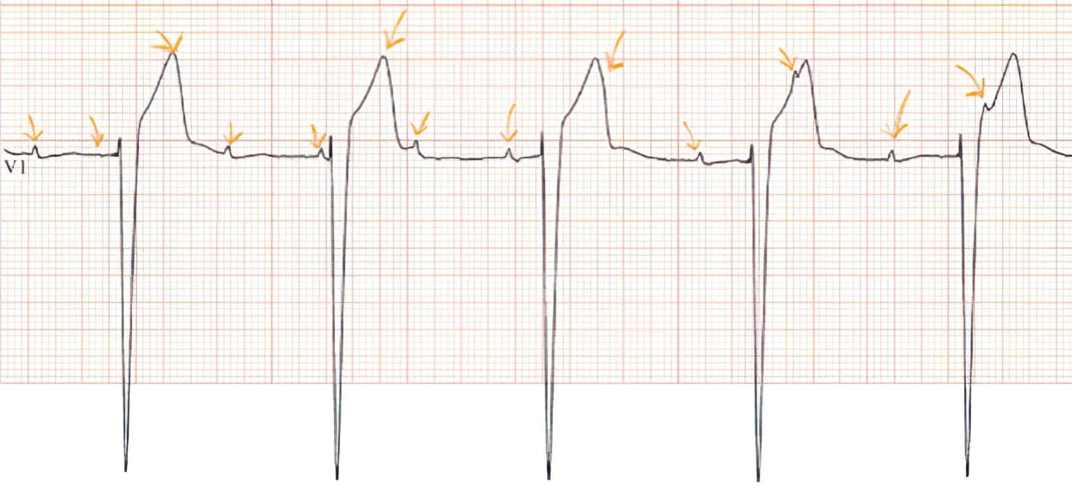 Topic - Third-Degree AV Block, Complete AV Block | 12-Lead ECG ...