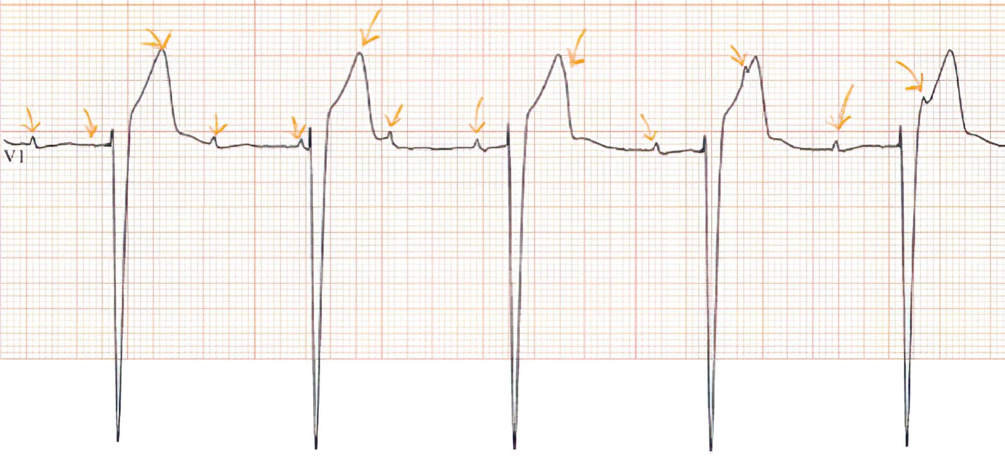 Topic - Third-Degree AV Block, Complete AV Block | 12-Lead ECG ...