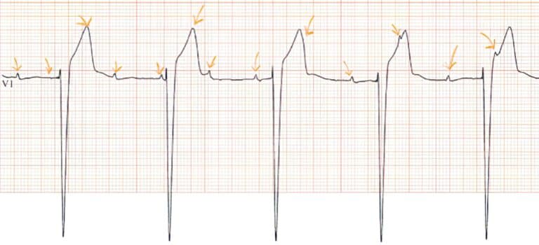 Topic - Third-Degree AV Block, Complete AV Block | 12-Lead ECG ...