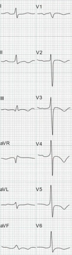 Topic - Changes in the T Wave | 12 Lead ECG Course | ACLS Certification ...