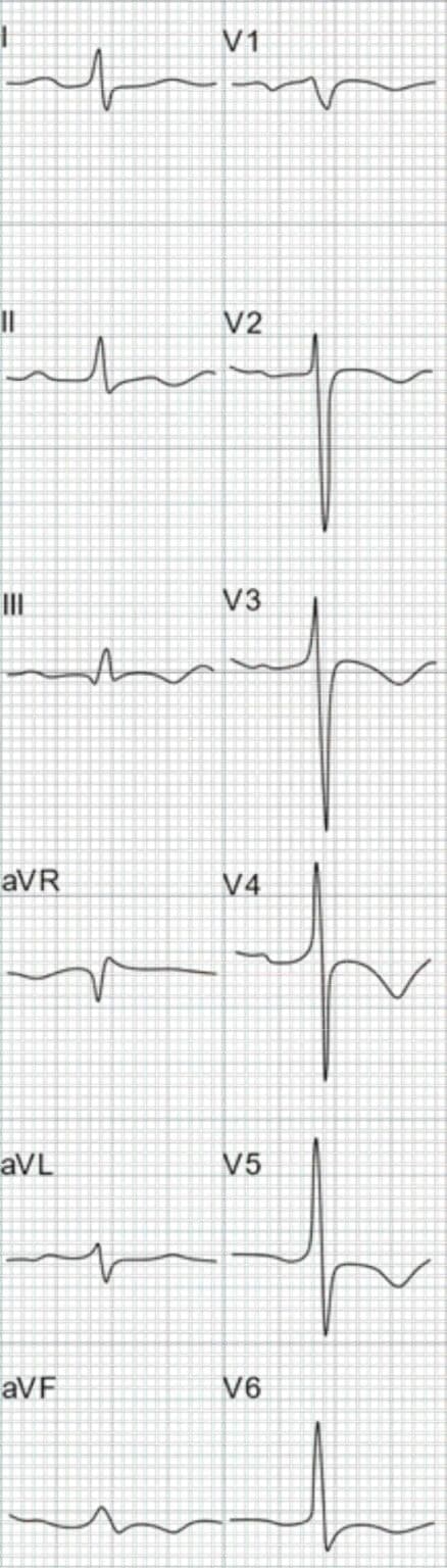 Topic - Changes in the T Wave | 12 Lead ECG Course | ACLS Certification ...