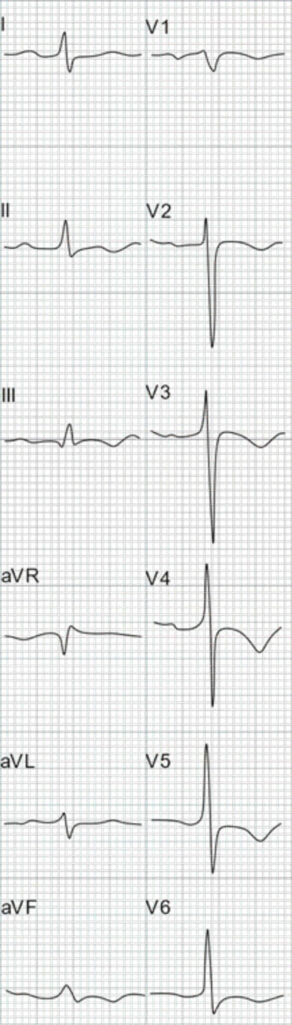 Topic - Changes in the T Wave | 12 Lead ECG Course | ACLS Certification ...