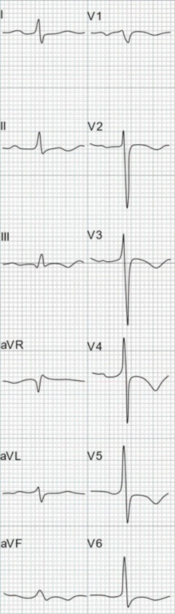 Topic - Changes in the T Wave | 12 Lead ECG Course | ACLS Certification ...