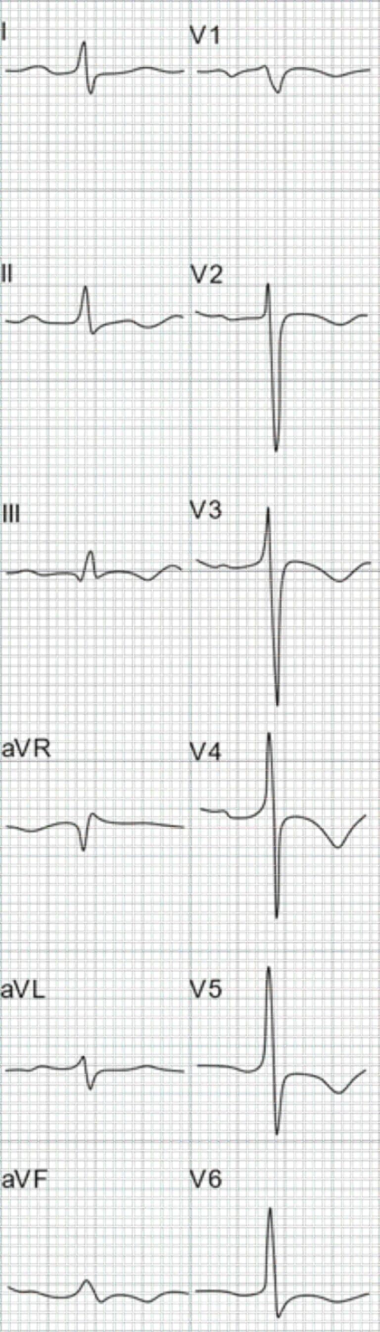 Topic - Changes in the T Wave | 12 Lead ECG Course | ACLS Certification ...