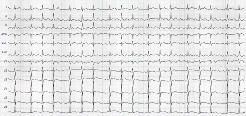 Topic - Atrial Flutter | 12 Lead ECG Course | ACLS Certification ...