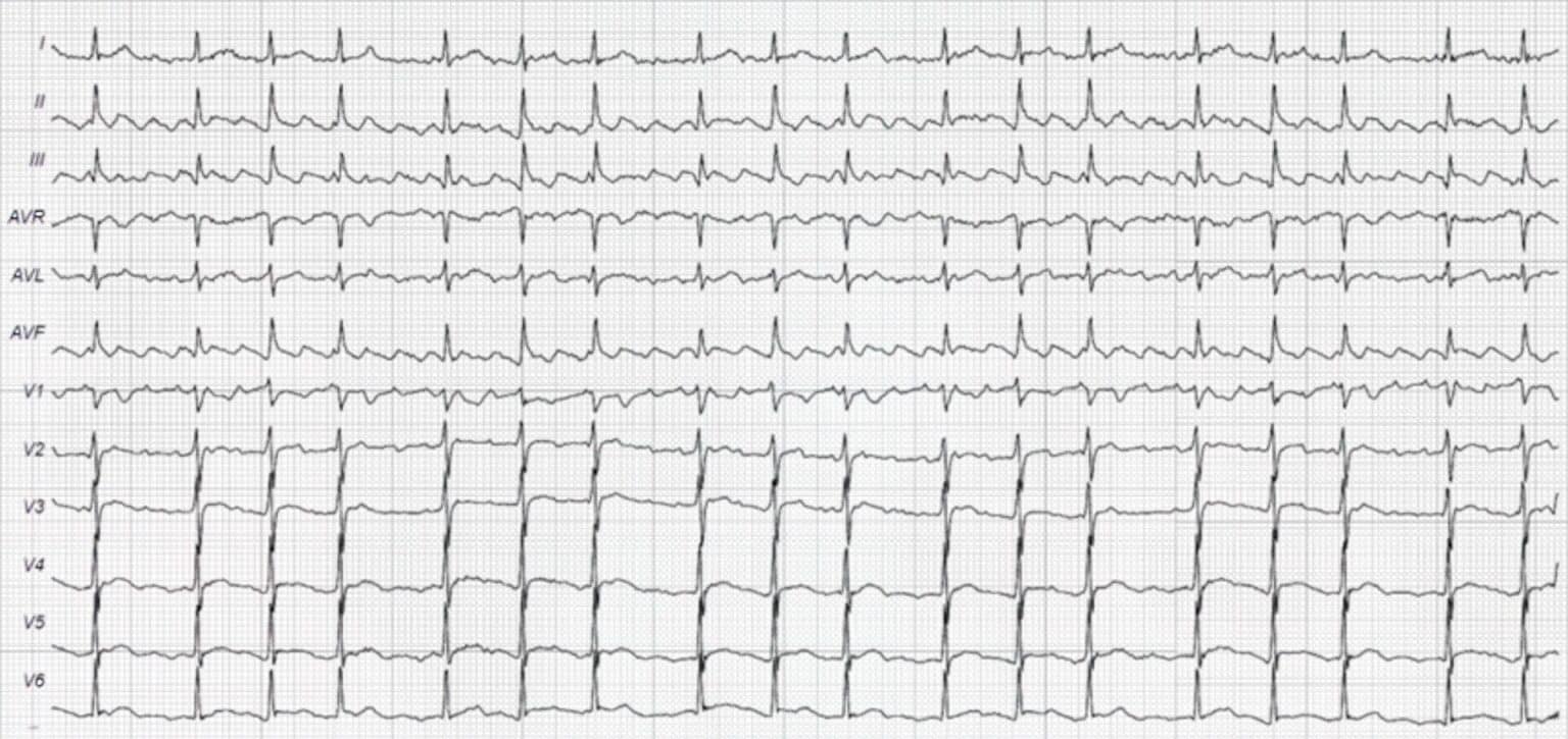 Topic - Atrial Flutter | 12 Lead ECG Course | ACLS Certification ...
