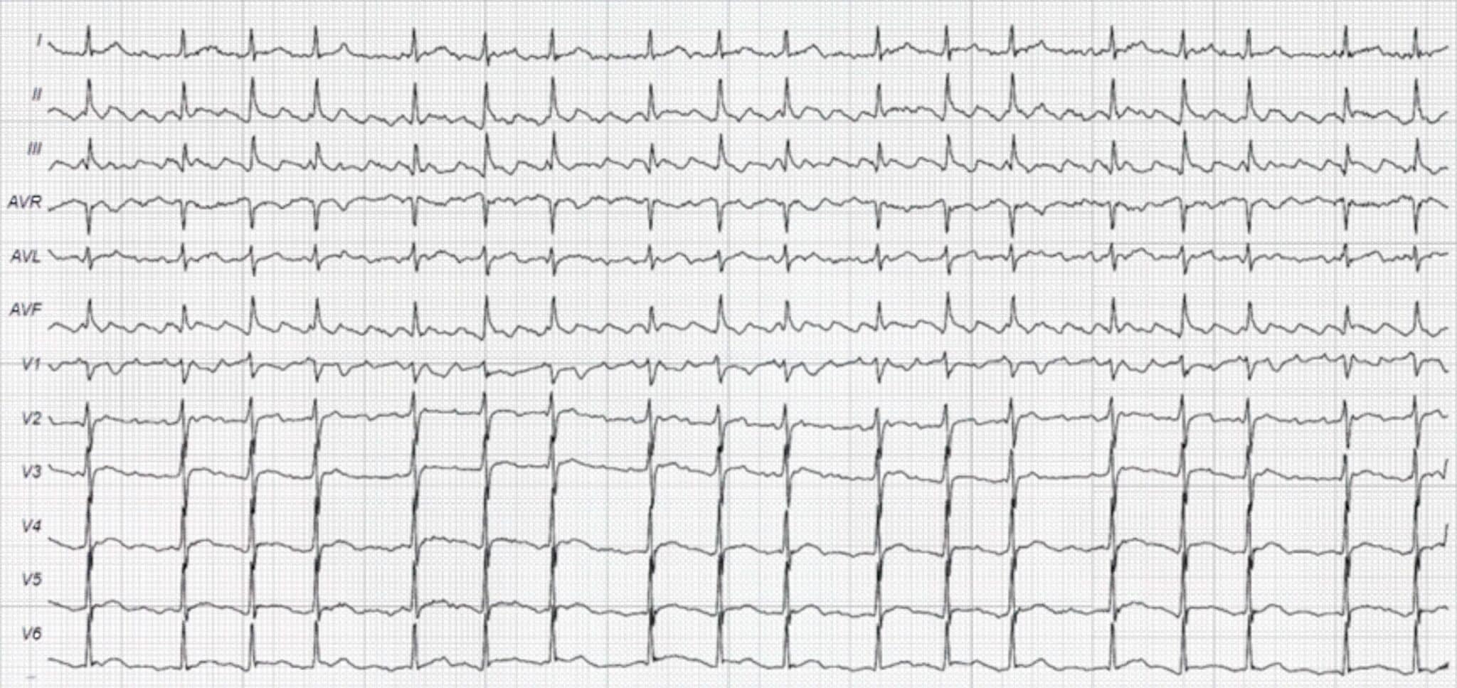 Topic - Atrial Flutter | 12 Lead ECG Course | ACLS Certification ...