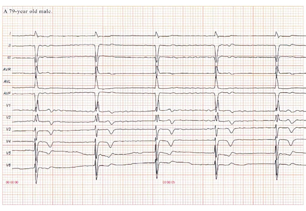 Topic - Incomplete Right Bundle Branch Block | 12-Lead ECG ...