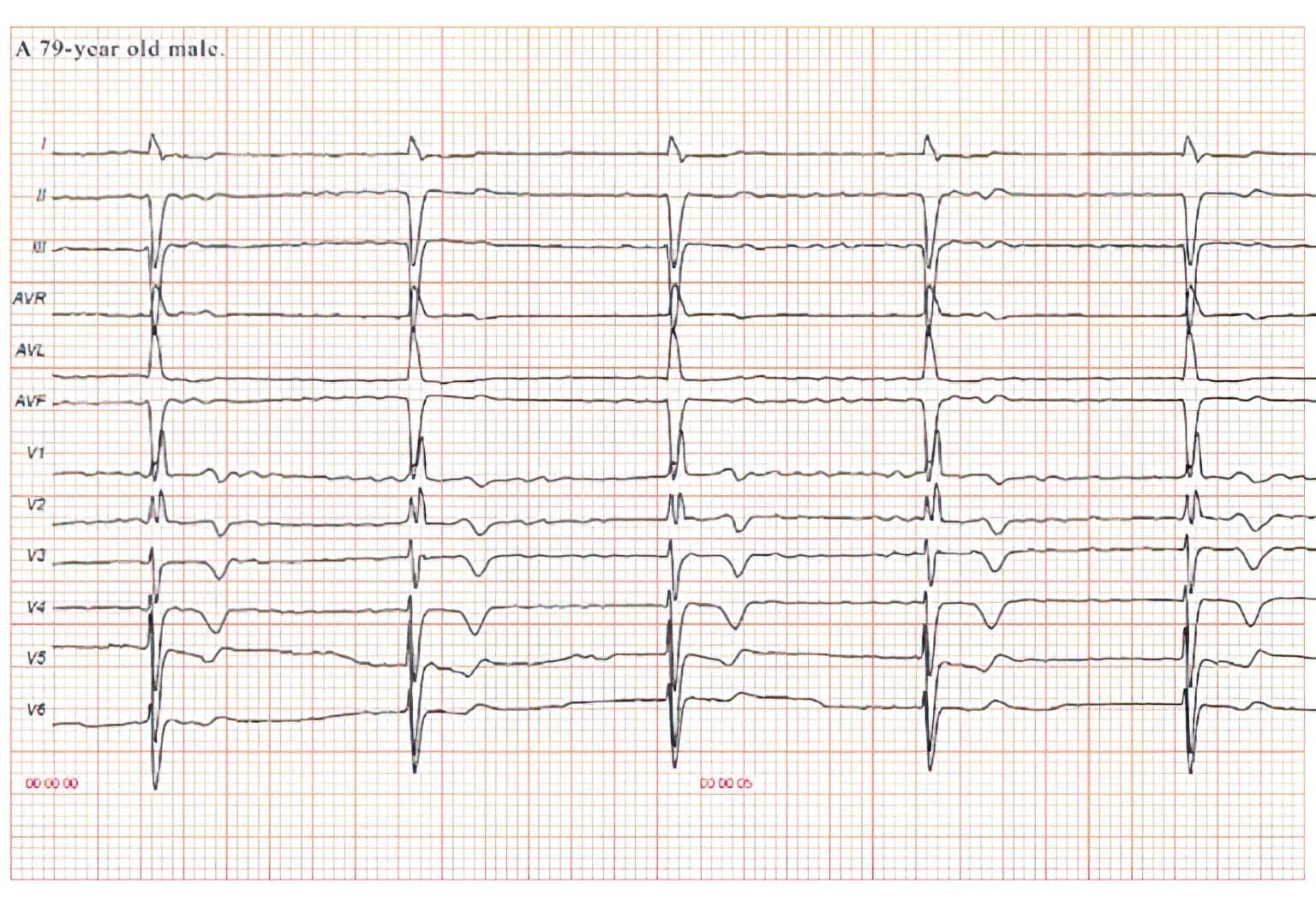 Topic - Incomplete Right Bundle Branch Block | 12-Lead ECG ...