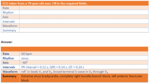 Topic - Incomplete Right Bundle Branch Block | 12-Lead ECG ...