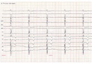 Topic - Incomplete Right Bundle Branch Block | 12-Lead ECG ...