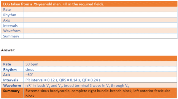 Topic - Incomplete Right Bundle Branch Block | 12 Lead ECG Course ...