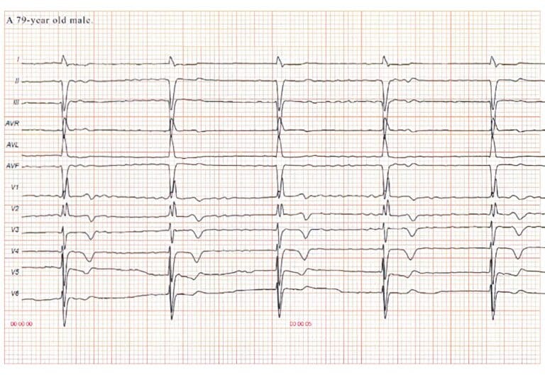 Topic - Incomplete Right Bundle Branch Block | 12-Lead ECG ...