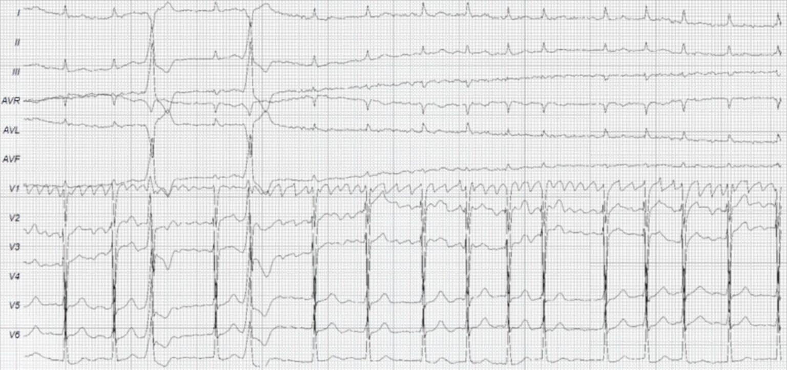 Topic - Atrial Fibrillation | 12 Lead ECG Course | ACLS Certification ...