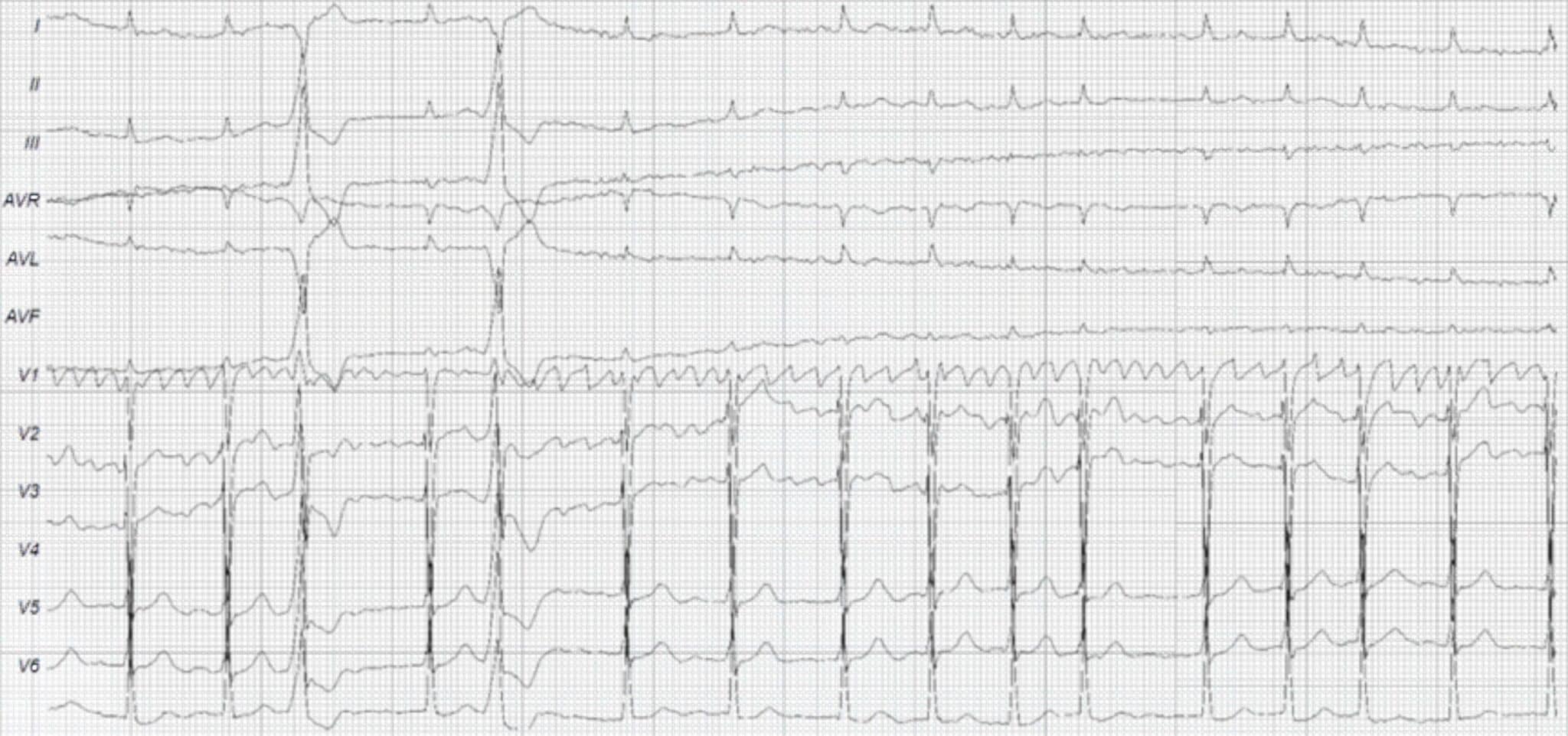 Topic - Atrial Fibrillation | 12 Lead ECG Course | ACLS Certification ...